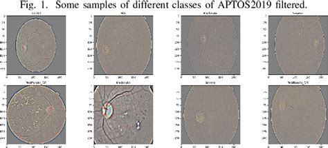 Figure From Early Detection And Classification Of Diabetic Retinopathy Through Analysis Of