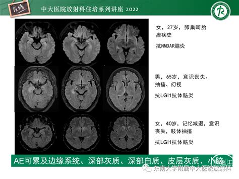 边缘系统受累疾病影像诊断与鉴别 脑医汇