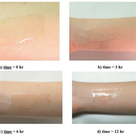 Ph Viscosity Spreadability And Skin Irritation Test Of Organogel Download Scientific Diagram