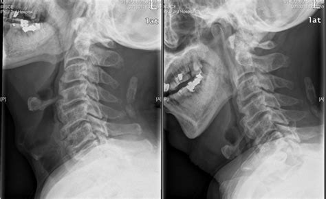 Cervical X Ray Of The Patient With Diffuse Idiopathic Skeletal