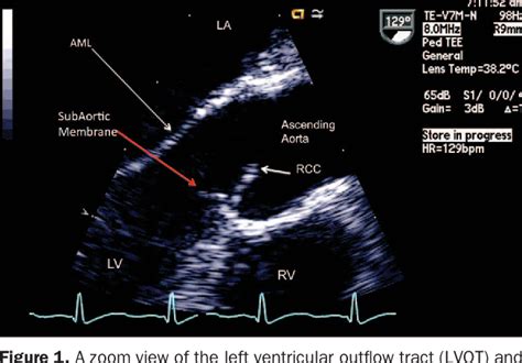 Figure 1 From Echo Rounds Discrete Subvalvular Aortic Stenosis Semantic Scholar
