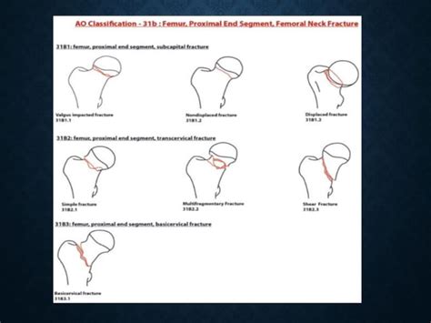 Neck Of Femur Fracture Its Classification And Treatment Ppt