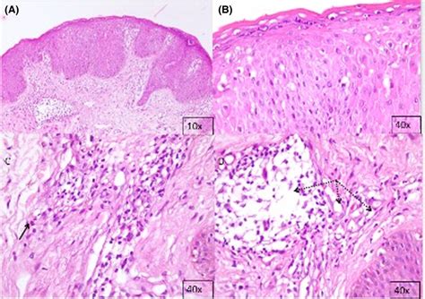 A And B Light Epidermal Acanthosis And Light Epidermal Spongiosis C