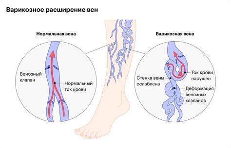 Удаление варикозных вен на ногах