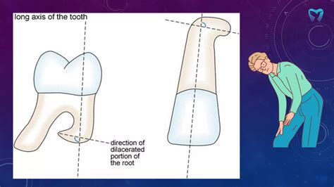 Dilaceration Pdf Pdf