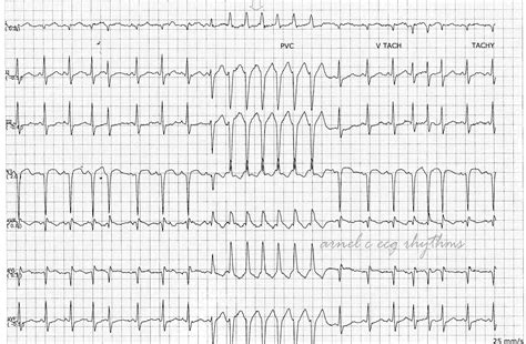 Nsvt ショートランとvtの違い 非持続性心室頻拍 Ynrpo