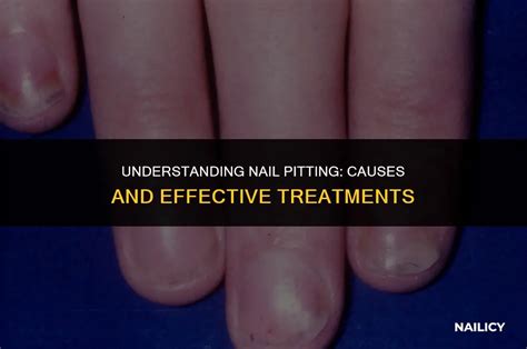 Understanding Nail Pitting Causes And Effective Treatments Nailicy