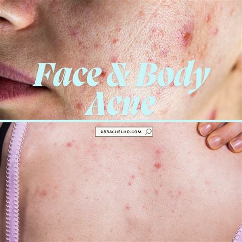 Dr Rachel Ho Exercise And Your Skin A Doctors Skin Guide For Athletes