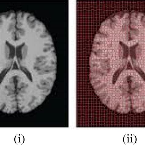 Sample Image Of Normal And Dementia Mr Brain Image A Normal B