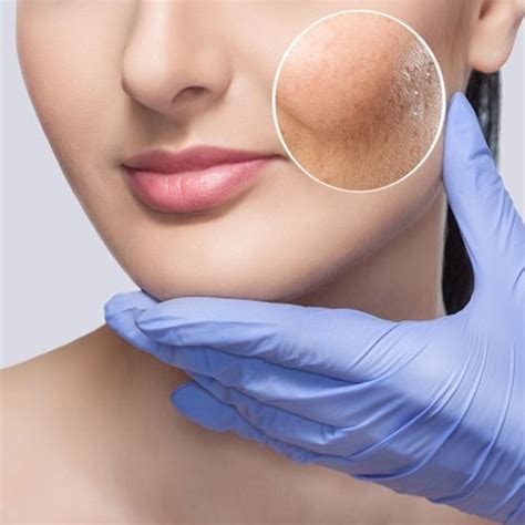 Unveiling Clear Skin Effective Acne Scar Treatment Options