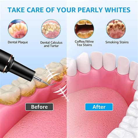 Dental Plaque Removal