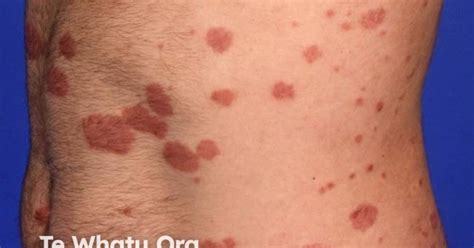 Chronic Plaque Psoriasis Image