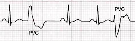 Premature Ventricular Contractions Pvcs