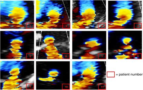 Clinical Data Used To Assess The Shape Of The Pisa Flow Convergence