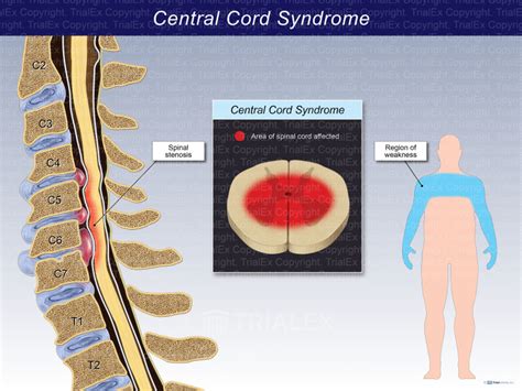 Central Cord Syndrome