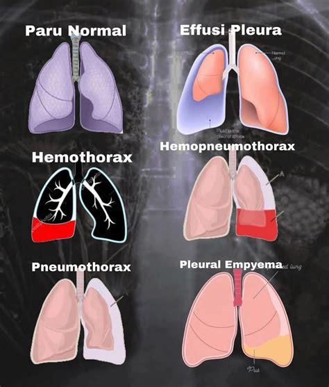 Normal Vs Abnormal Of Lung • Pleural Effusion Is The Buildup Of