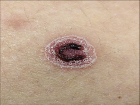 Malignant Syphilis Indian Journal Of Dermatology Venereology And