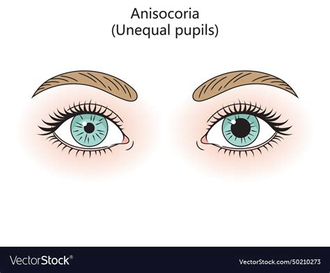 Human Anisocoria Diagram Medical Science Vector Image