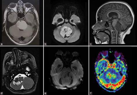 Fossa Posterior Posterior Cranial Fossa Tumor An Overview