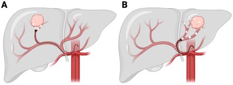 Advances And Emerging Techniques In Y 90 Radioembolization For