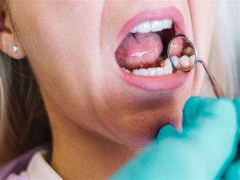 Mouth Cancer Pictures