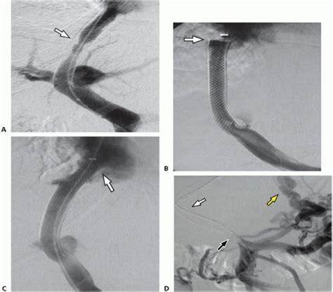 Pediatric Portal Vein Reconstruction Plastic Surgery Key