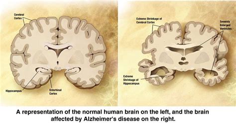 Alzheimers Disease A Brief History And Description