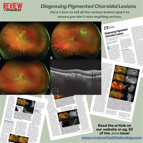 Diagnosing Pigmented Choroidal Review Of Ophthalmology Facebook