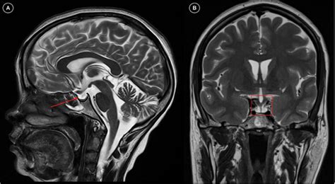 Sheehan Syndrome Unmasked By Adrenal Crisis Secondary To Severe Dengue