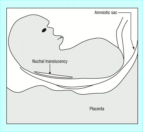 Using Fetal Nuchal Translucency To Screen For Major Congenital Cardiac