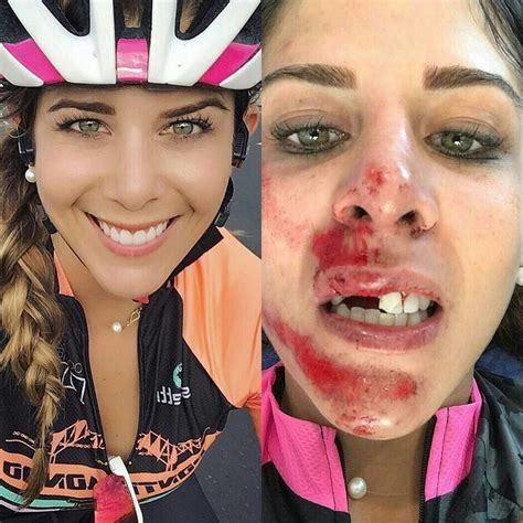 The Aftermath Of That Bunjee Jump Accident Album On Imgur