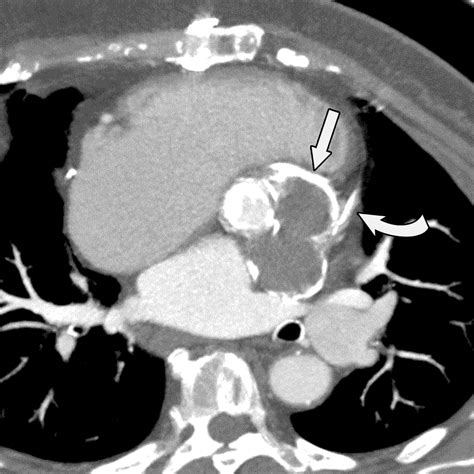 Imaging Features Of Complications After Coronary Interventions And
