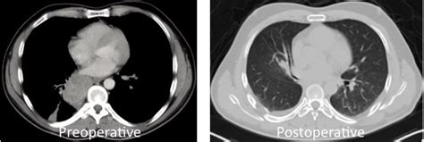 Single Incision Vats Sivats Segmentectomy For Lung Cancer Ctsnet