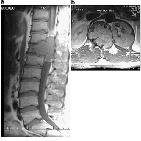 Thoracolumbar X Ray Showing A D12 Vertebral Body Abnormality With Download Scientific Diagram