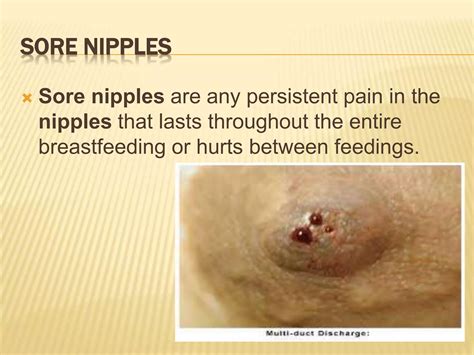 Pptofproblemsandcomplicationofbreastfeedingpptmadamkalyani 160818082451pdf