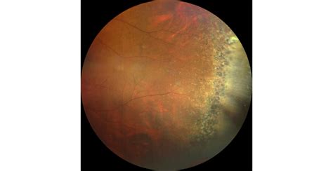 What Are These Peripheral Retinal Findings R Ophthalmology