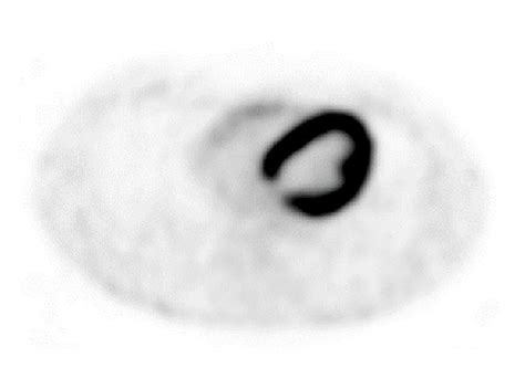Different Patterns Of Myocardial Fdg Distribution A None B