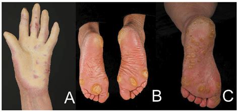 Hyperkeratosis Epidermolytic Erythroderma Ichthyosiforme