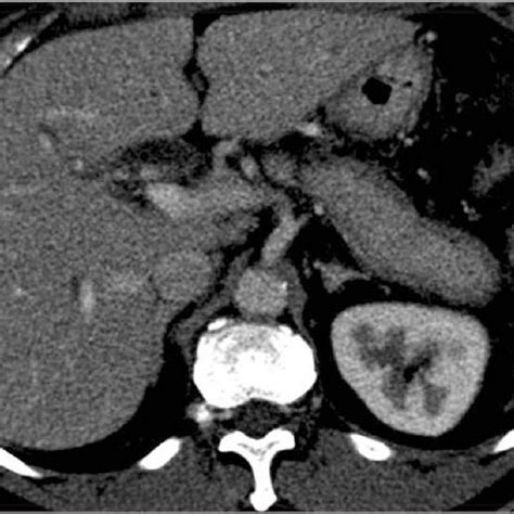 Diffuse Enlargement Of Pancreas Was Shown By Ultrasonography US Download Scientific Diagram