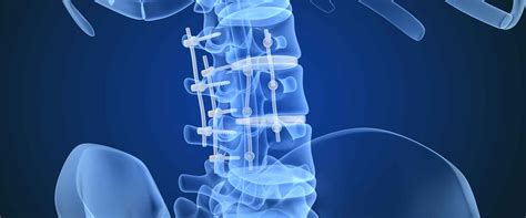 The Advantages Of Peek Cervical Implants And Spacers Genesis Medical
