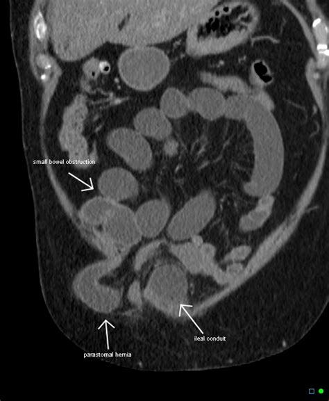 Parastomal Hernia With Obstruction At Dorla Walker Blog