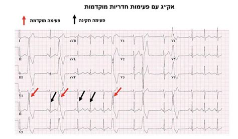 התכווצויות חדריות מוקדמות פרופ אלעד אנטר