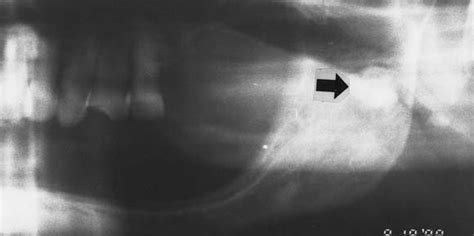 Tonsillolith A Case Report Journal Of Oral And Maxillofacial Surgery