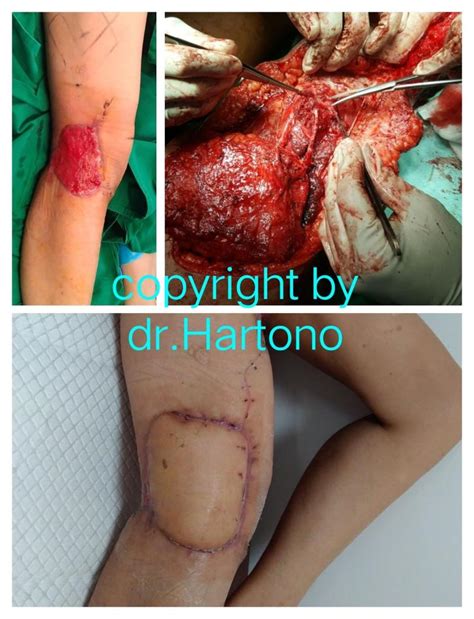 Drhartono S On Linkedin After Malignant Sarcoma Resection At Right Knee The Oncologist Had A