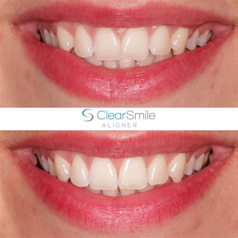 Clear Smile Clearsmile