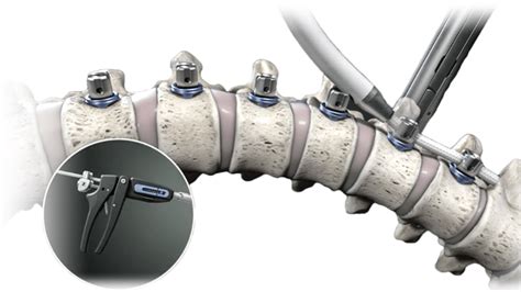 Flexibility Restored The Promise Of Vertebral Body Tethering For