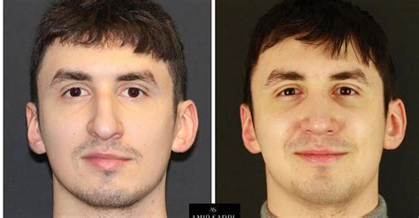 Operative Results Using Structural Rhinoplasty Techniques