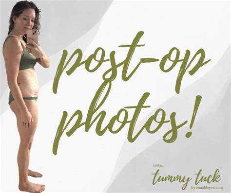 Two Weeks Post Op Photos Halifax Tummy Tuck