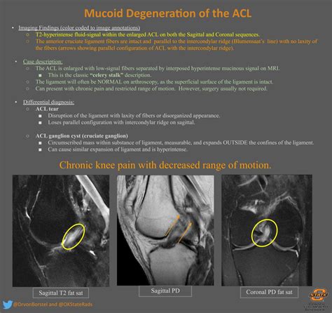 Mucoid Degeneration Of The Acl Imaging Findings • T2 Hyperintense