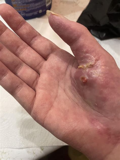 Lump Behind Ear Raskdoctorsmeeee